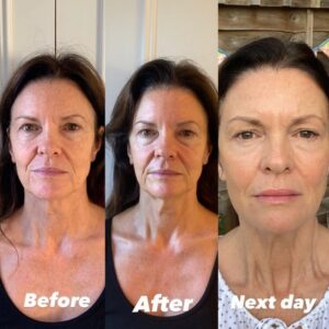 Gua Sha Before and After: Benefits and Results - Must Read This Before ...