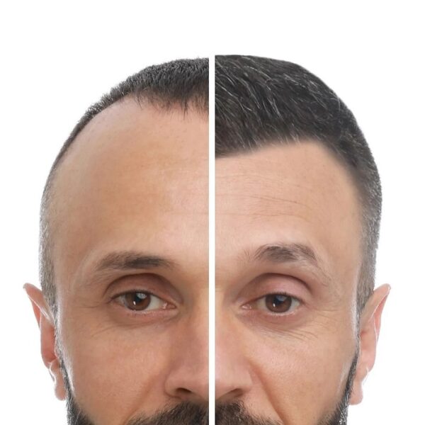 Minoxidil Before And After Real Results And Photos Must Read This