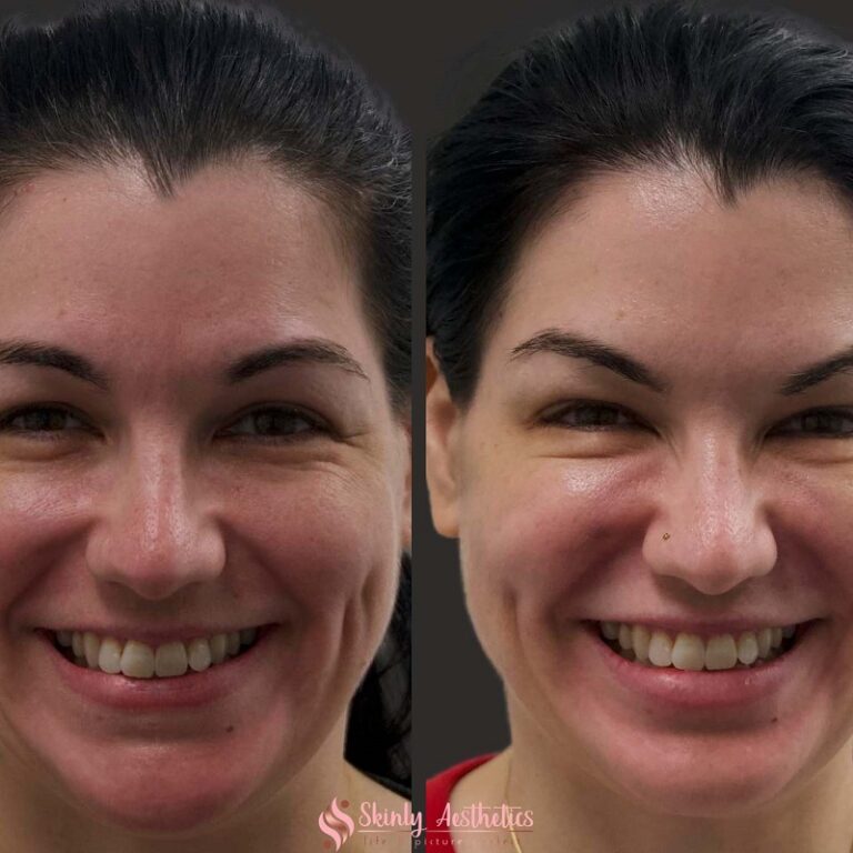 Botox Before and After: Dramatic Results and What to Expect - Must Read ...