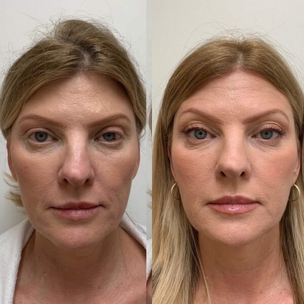 Sculptra Before And After Transforming Your Appearance With Long