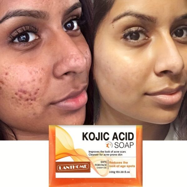 Kojic Acid Soap Before And After Does It Really Lighten Skin Must Read This Before Buying