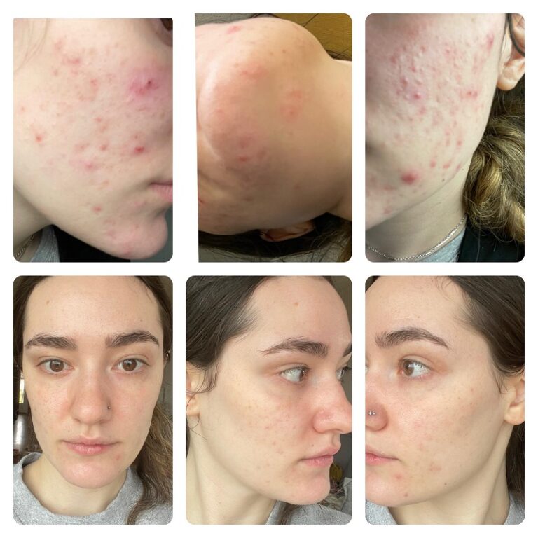 Tretinoin Before and After: A Comprehensive Analysis of its Effectiveness on Skin - Must Read ...