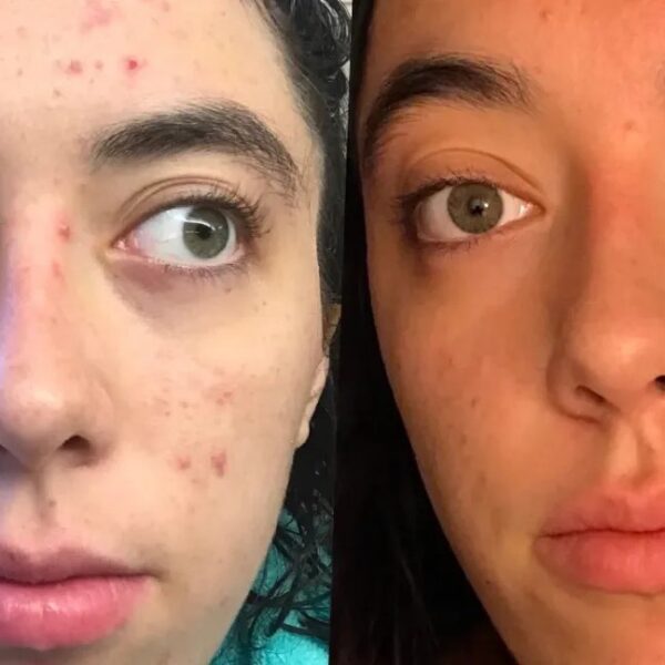 Tretinoin Before and After: A Comprehensive Analysis of its Effectiveness on Skin - Must Read ...