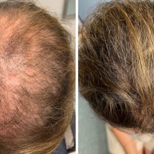 Minoxidil Before and After: Real Results and Photos - Must Read This ...