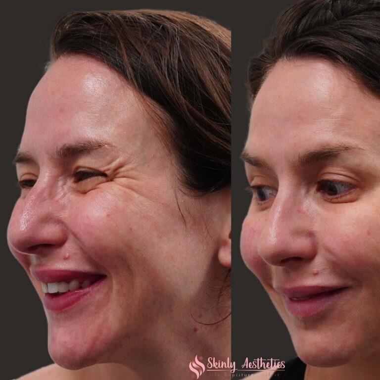 Botox Before and After: Dramatic Results and What to Expect - Must Read This Before Buying