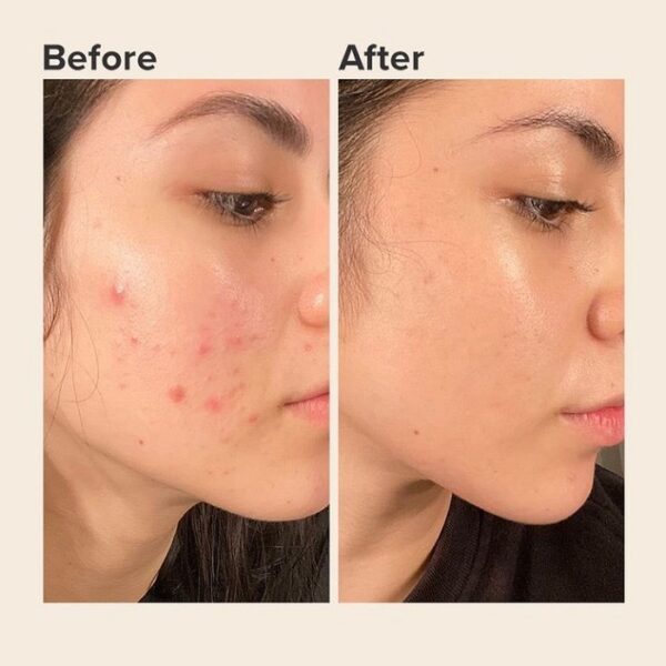 Retinol Before and After: Transform Your Skin with These Results - Must ...