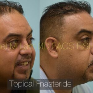 Minoxidil Before and After: Real Results and Photos - Must Read This ...