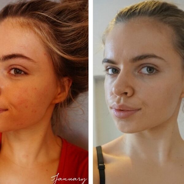 The Ordinary Peeling Solution Before and After: A Comprehensive Review ...