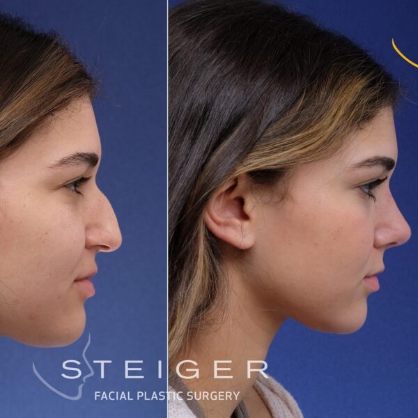Nose Job Before and After: Dramatic Transformations and What to Expect ...