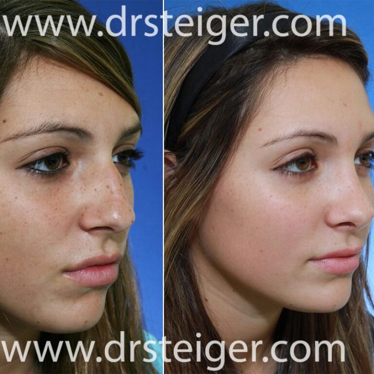 Nose Job Before and After: Dramatic Transformations and What to Expect ...