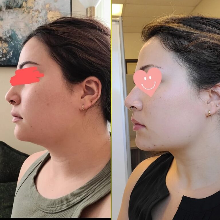 Mewing Before and After: Transforming Your Face with Proper Tongue ...