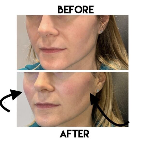 Cheek Filler Before and After: Transforming Your Appearance with Subtle ...