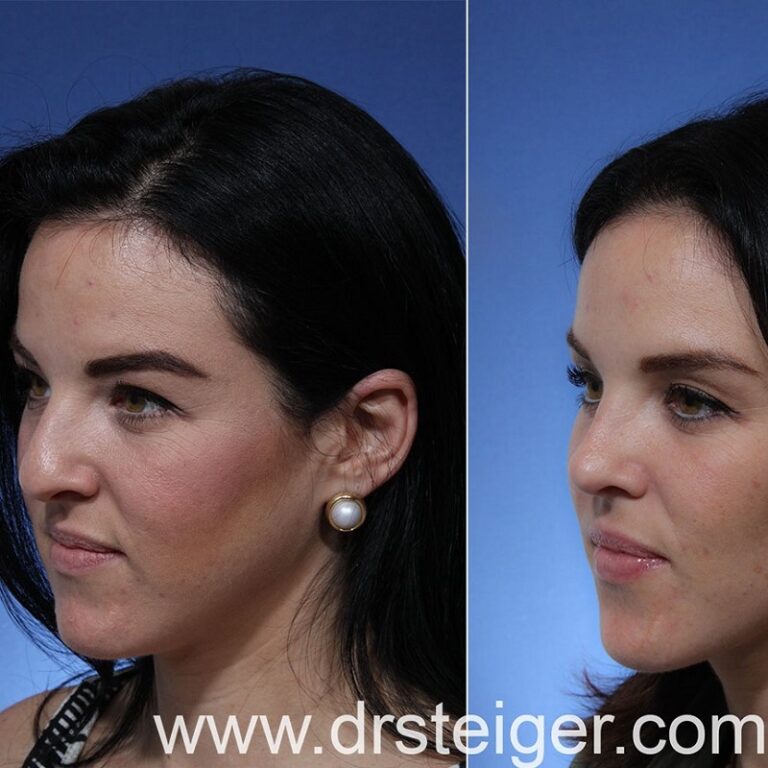 Nose Job Before and After: Dramatic Transformations and What to Expect ...