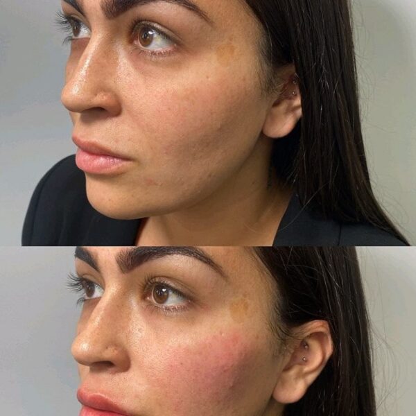 Cheek Filler Before and After: Transforming Your Appearance with Subtle ...