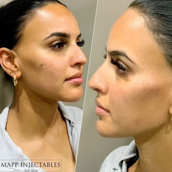 Cheek Filler Before and After: Transforming Your Appearance with Subtle ...