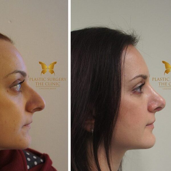 Nose Job Before and After: Dramatic Transformations and What to Expect ...