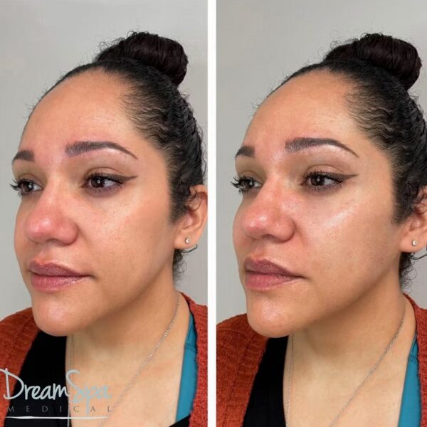 Cheek Filler Before and After: Transforming Your Appearance with Subtle ...