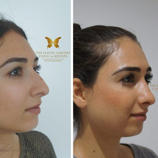 Nose Job Before and After: Dramatic Transformations and What to Expect ...