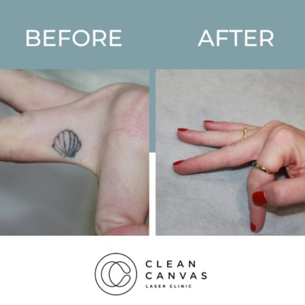 Tattoo Removal Before and After: What You Need to Know - Must Read This ...