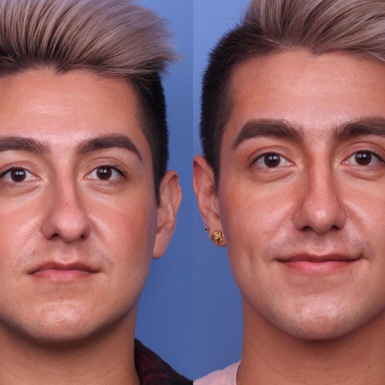 Nose Job Before and After: Dramatic Transformations and What to Expect - Must Read This Before ...