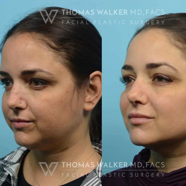 Buccal Fat Removal Before and After: What You Need to Know - Must Read ...