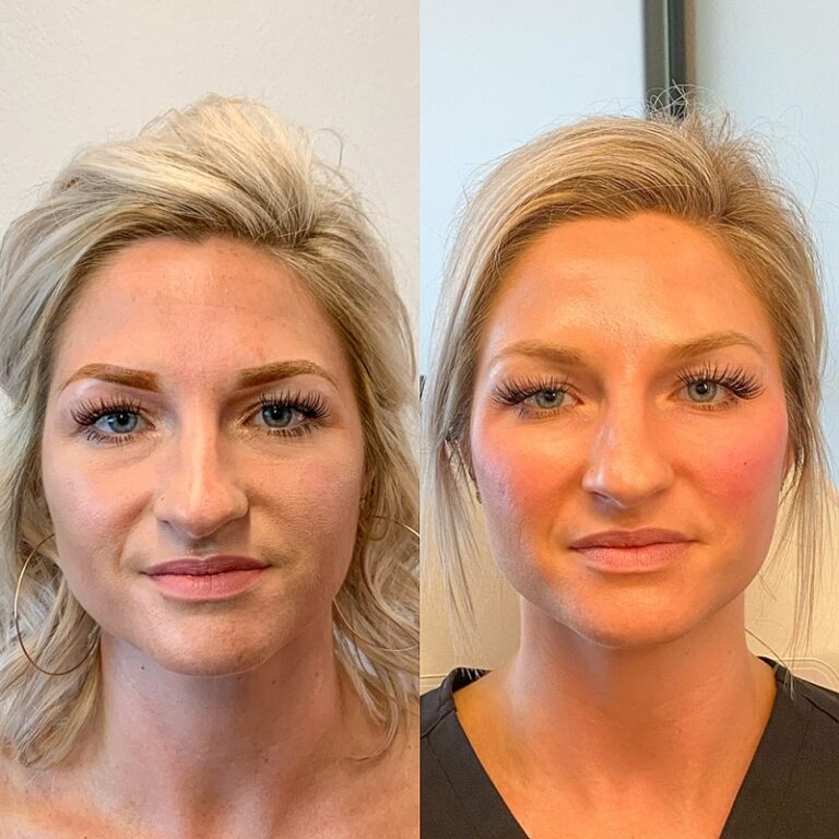 Cheek Filler Before and After: Transforming Your Appearance with Subtle ...