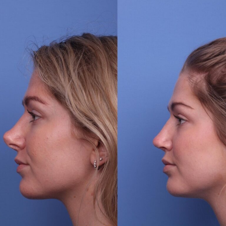 Nose Job Before and After: Dramatic Transformations and What to Expect ...