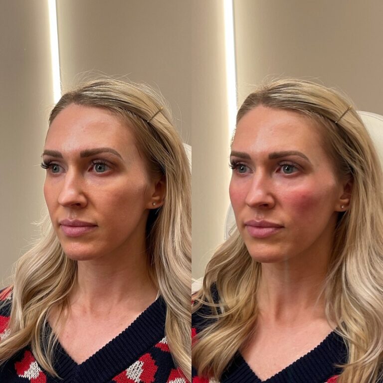 Cheek Filler Before and After: Transforming Your Appearance with Subtle ...