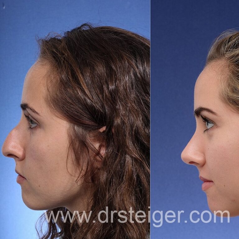 Nose Job Before and After: Dramatic Transformations and What to Expect ...