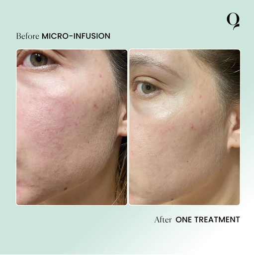 Qure MicroInfusion Review: Does It Live Up to the Claims or Just a ...